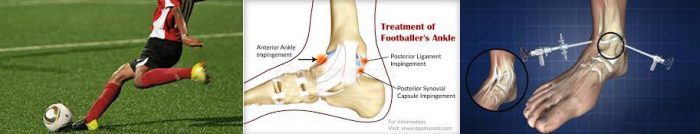 Footballer’s Ankles | A+ Orthopaedics & Sports Med Center|New Delhi