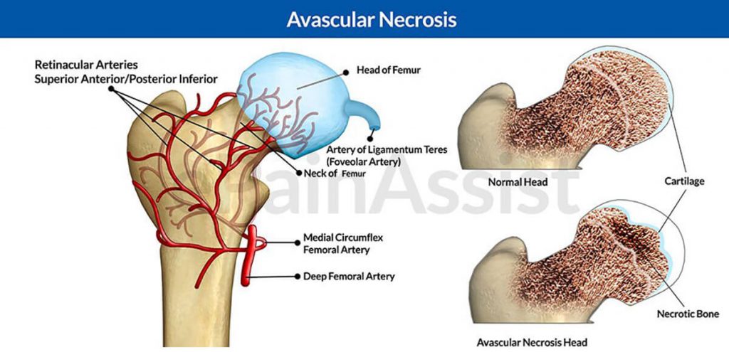 Avascular Necrosis | A+ Orthopaedics & Sports Med Center|New Delhi