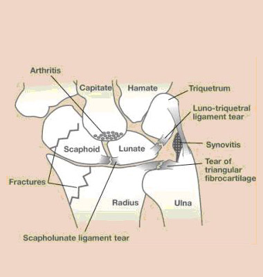 Wrist Arthroscopy | A+ Orthopaedics & Sports Med Center|New Delhi