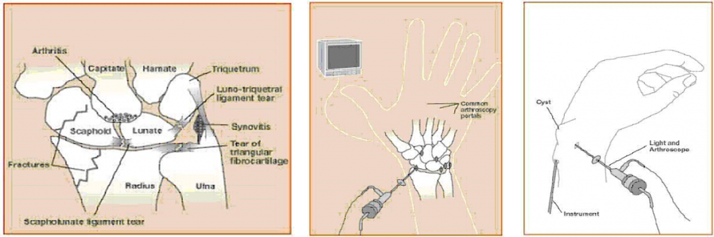 Wrist Arthroscopy | A+ Orthopaedics & Sports Med Center|New Delhi