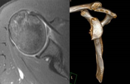 Shoulder Instability Injury - A+ Orthopaedics & Sports Med Center