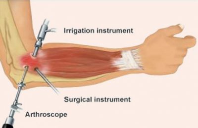 Elbow Arthroscopy | A+ Orthopaedics & Sports Med Center|New Delhi