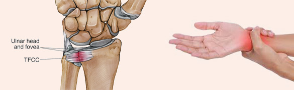 TFCC Tear | A+ Orthopaedics & Sports Med Center|New Delhi