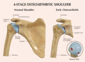 OA Shoulder | A+ Orthopaedics & Sports Med Center|New Delhi