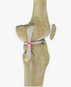 LCL Injury | A+ Orthopaedics & Sports Med Center|New Delhi