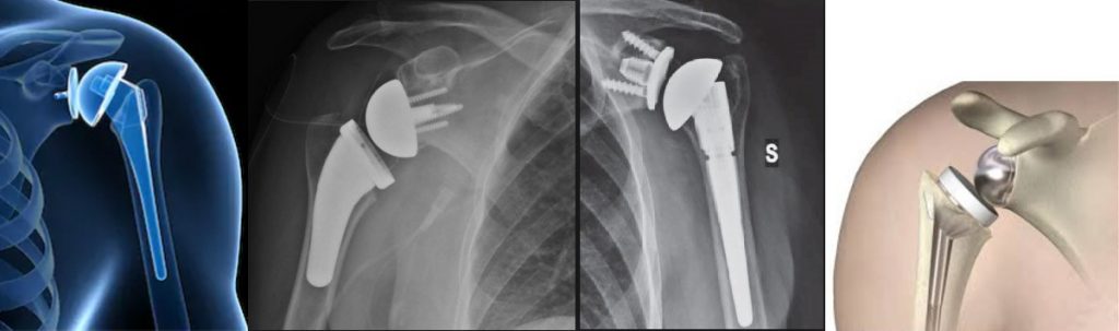 OA Shoulder | A+ Orthopaedics & Sports Med Center|New Delhi