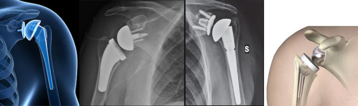 OA Shoulder | A+ Orthopaedics & Sports Med Center|New Delhi