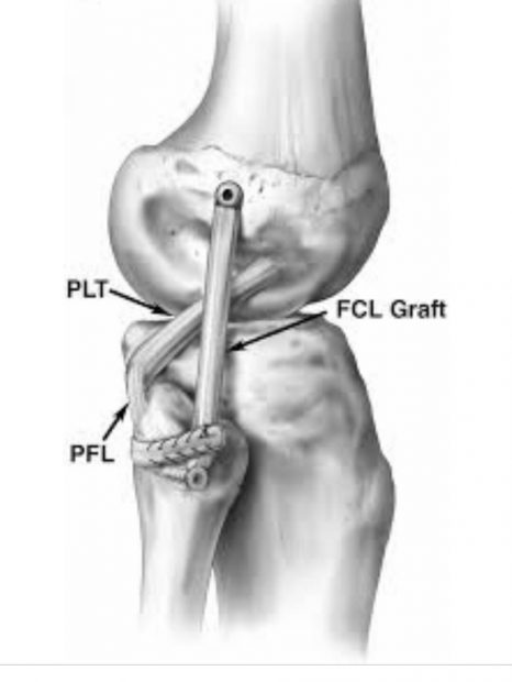 PLC Injuries | A+ Orthopaedics & Sports Med Center|New Delhi